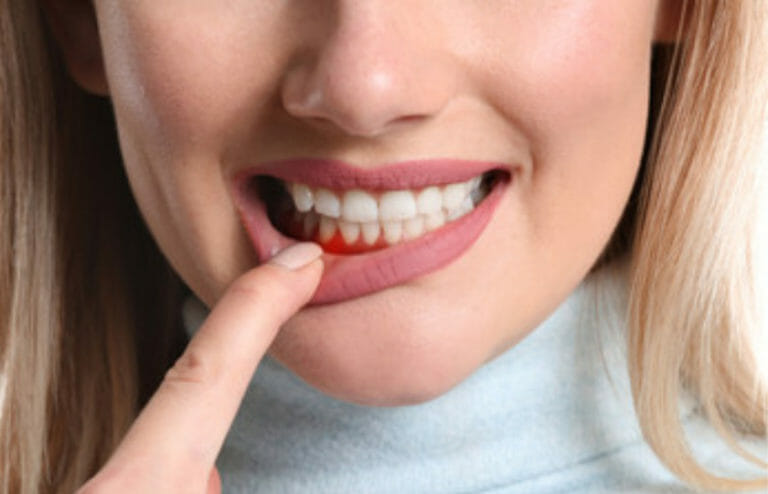 What Is The Relationship Between Plaque And Gum Disease?